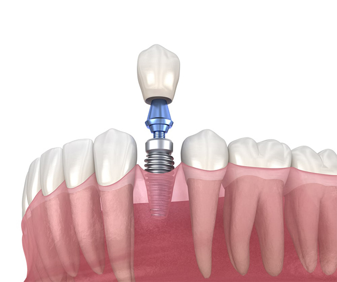 Missing Single Tooth