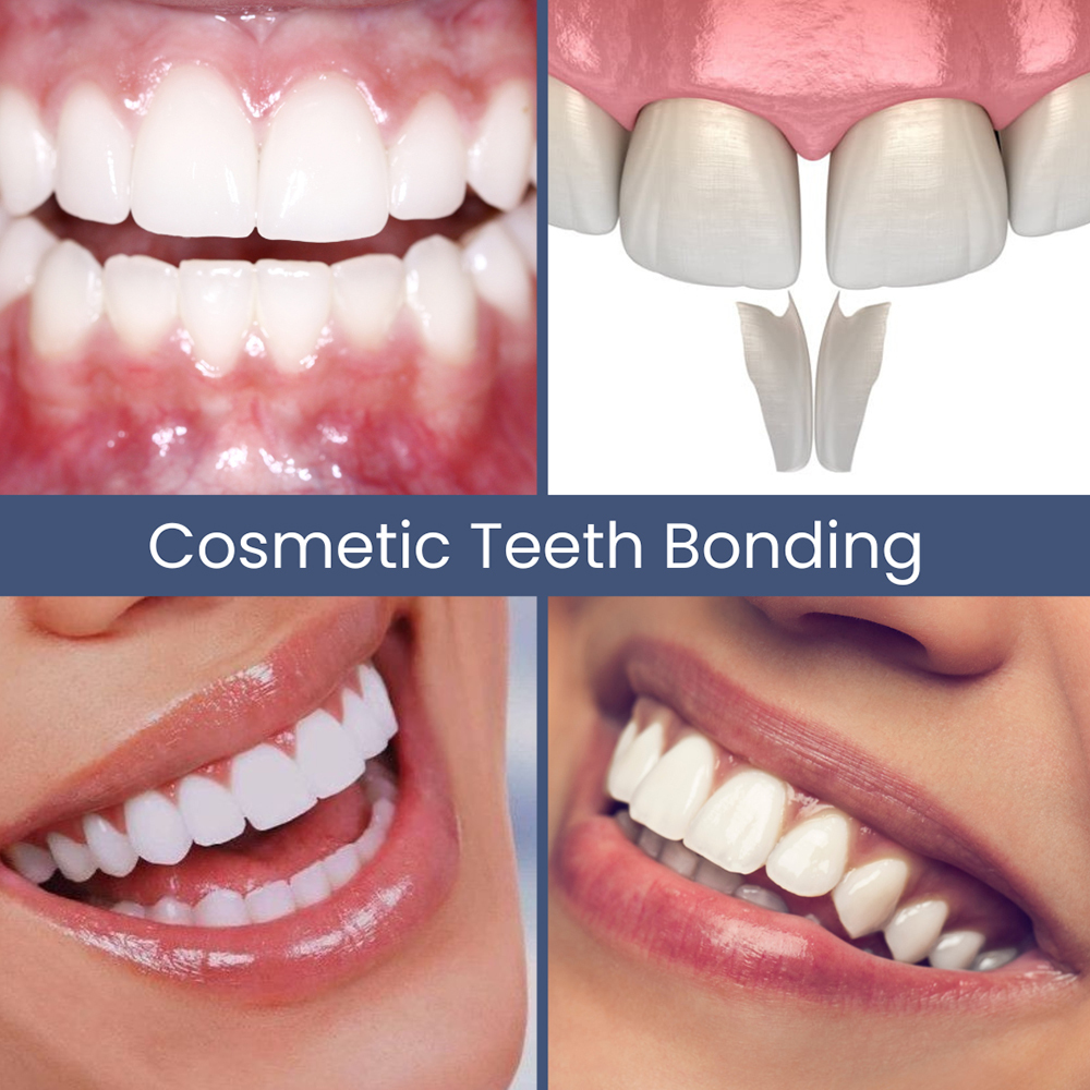 Dental Bonding Rockville Centre, NY | Cosmetic Teeth Bonding
