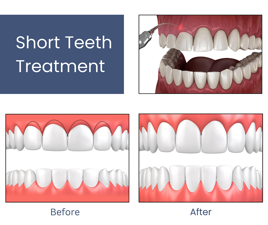 Small Teeth Treatment Rockville Centre | Veneers for Small Teeth in NY